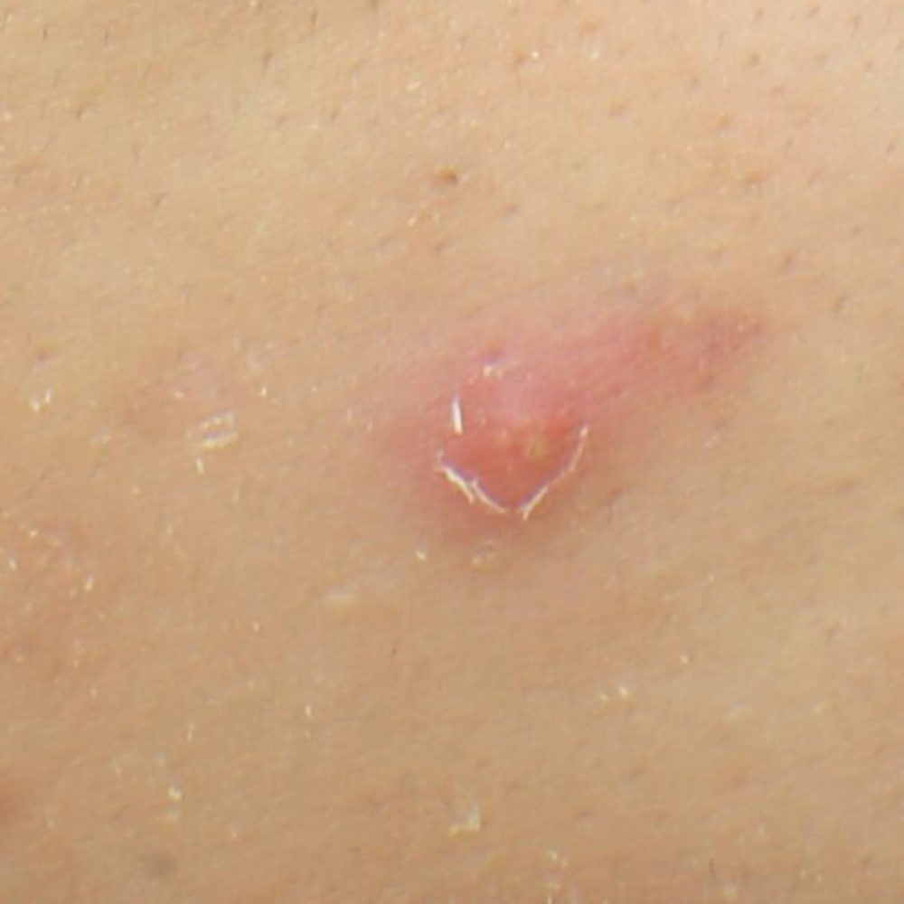 RIGHT AWAY MICROTIP SPOT PATCH – KNEMO Beauty
